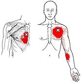 Stock Illustration of Triceps brachii m., trigger points mm115006 ...